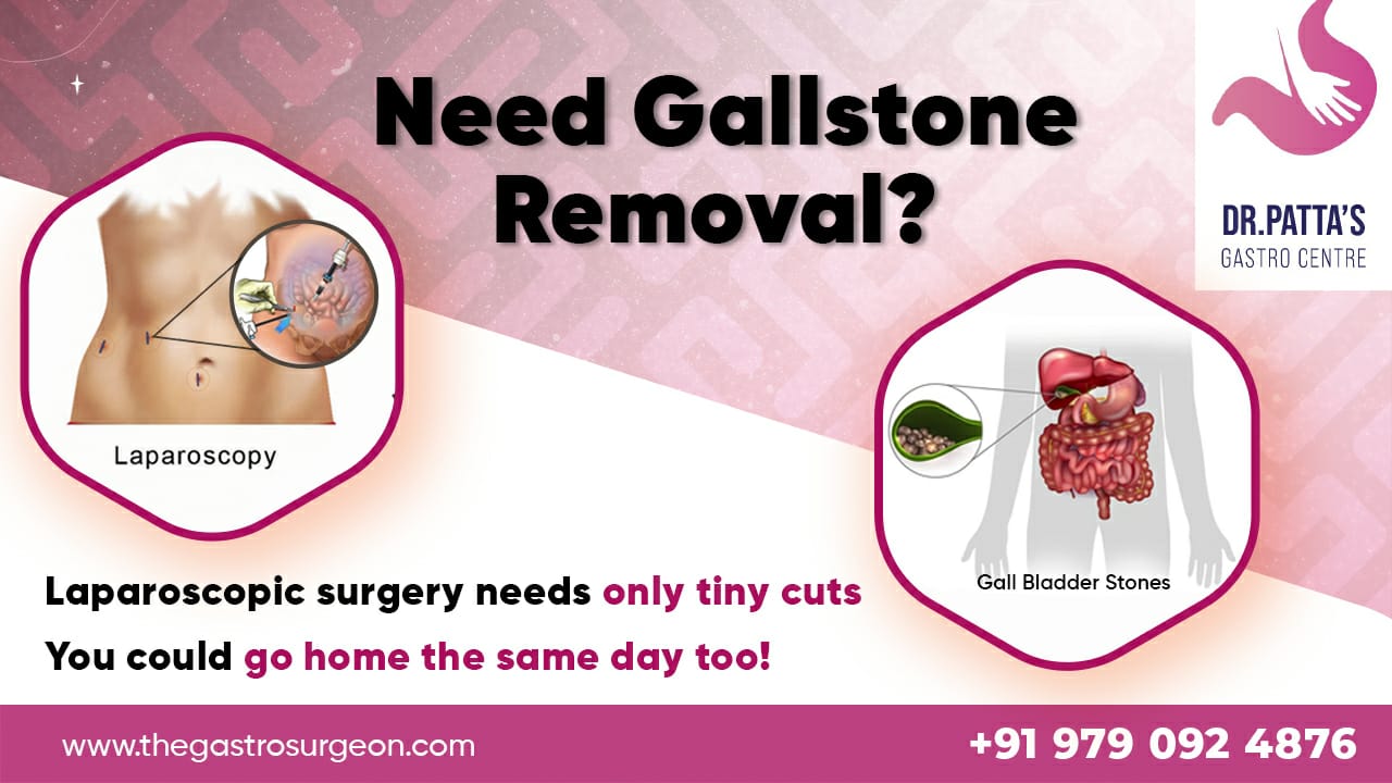 Gallstones surgery Types, Procedure | Gallbladder removal