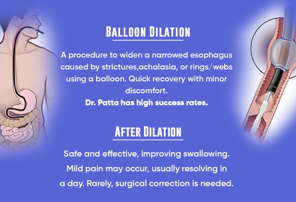 Effective Balloon Dilation for Esophageal Strictures in Chennai