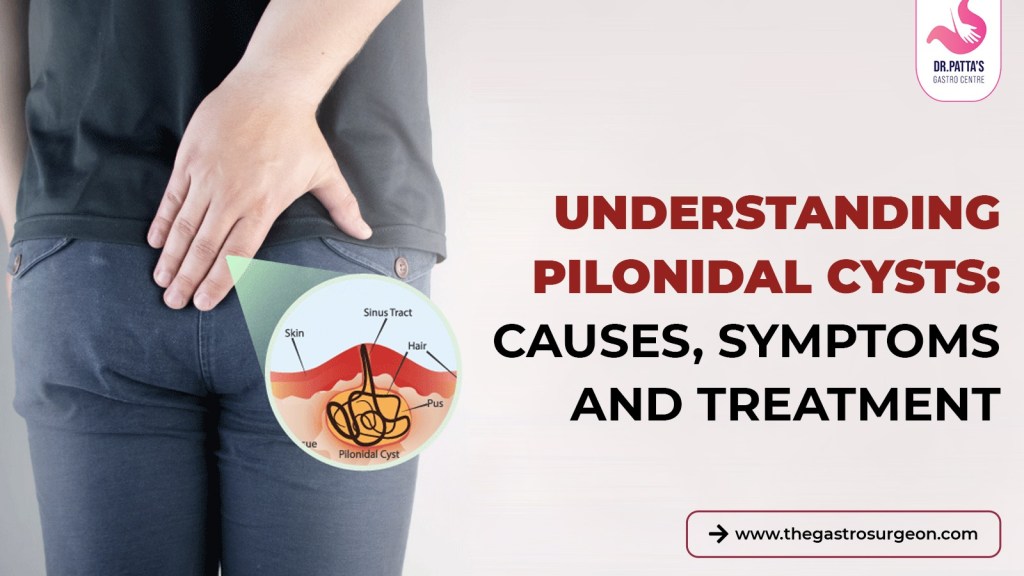 Pilonidal Cyst: Causes, Symptoms & Treatment